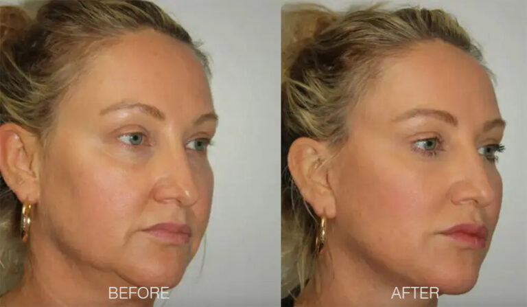 Deep Plane Facelift Recovery Guide - Boris M. Ackerman, M.D.